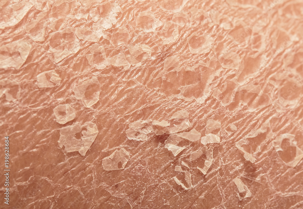 texture of the unhealthy human skin epidermis with flaky and cracked ...