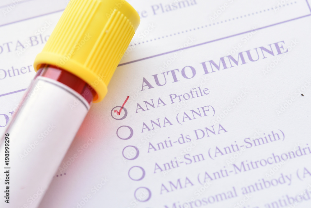 Blood sample for antinuclear antibody (ANA) test, autoimmune diagnosis ...