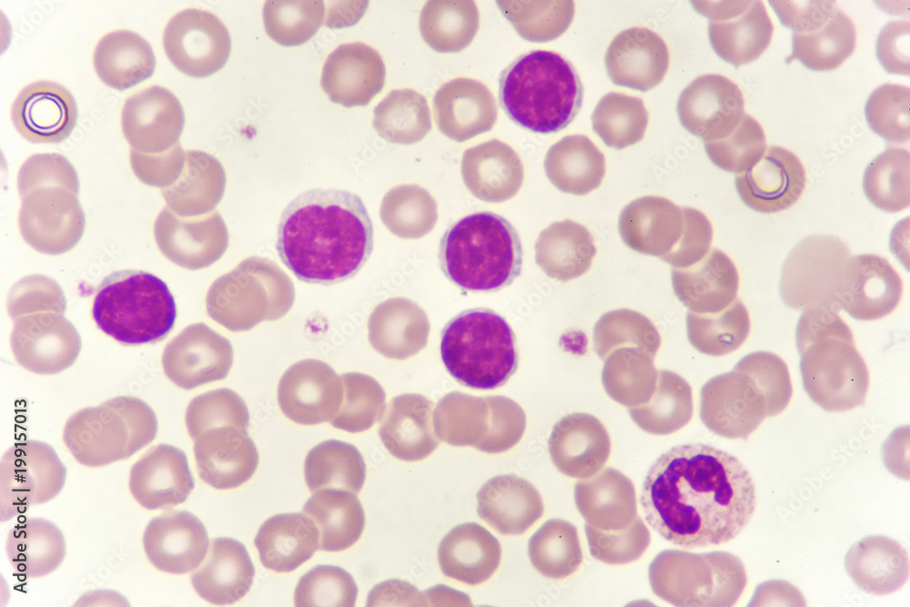 Blood smear of chronic lymphocytic leukemia (CLL), analyze by ...