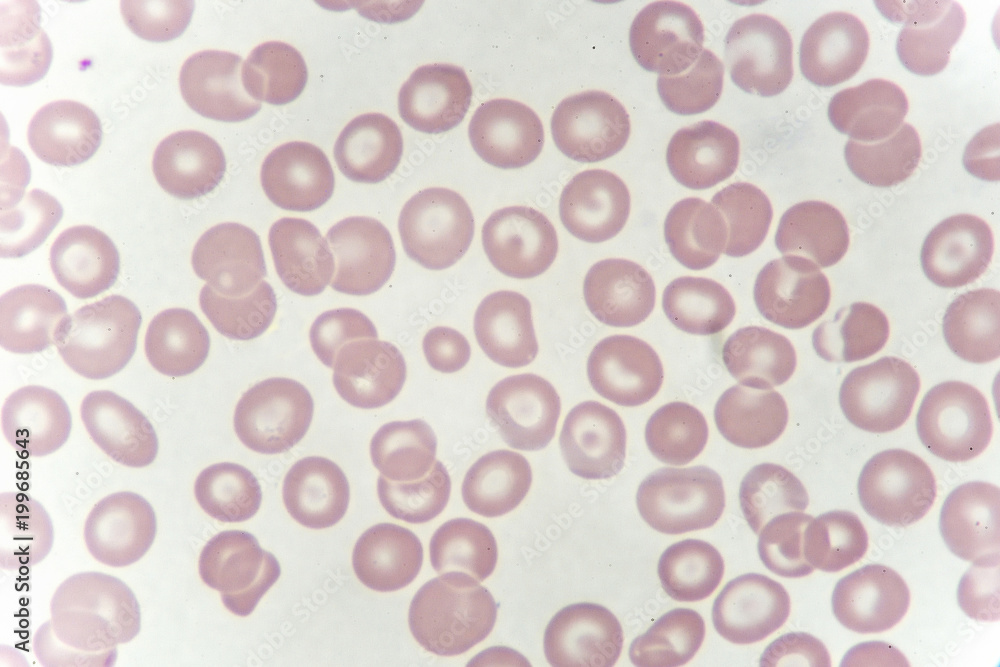Photo Stock Target cells with abnormal red blood cells from anemia ...