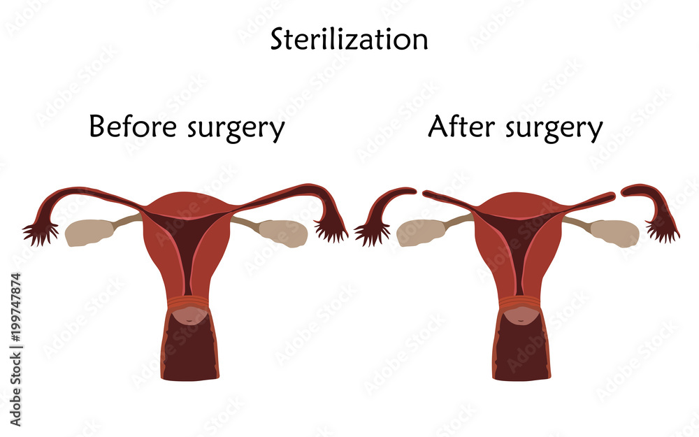 Woman sterilization, before and after surgery. Human realistic uterus ...