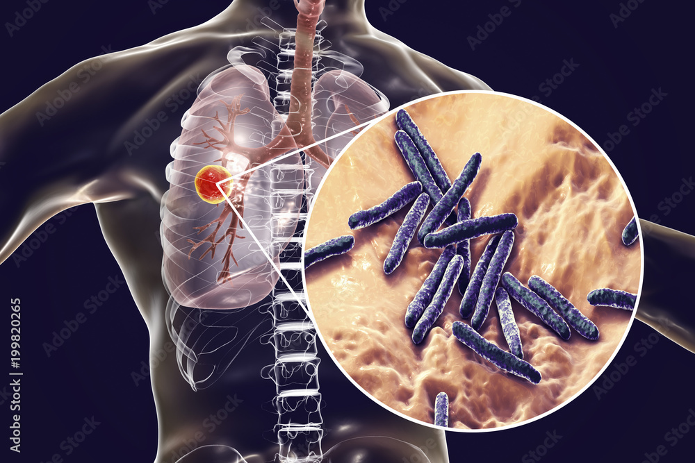 Ilustração Fibrous-cavernous pulmonary tuberculosis and close-up view ...