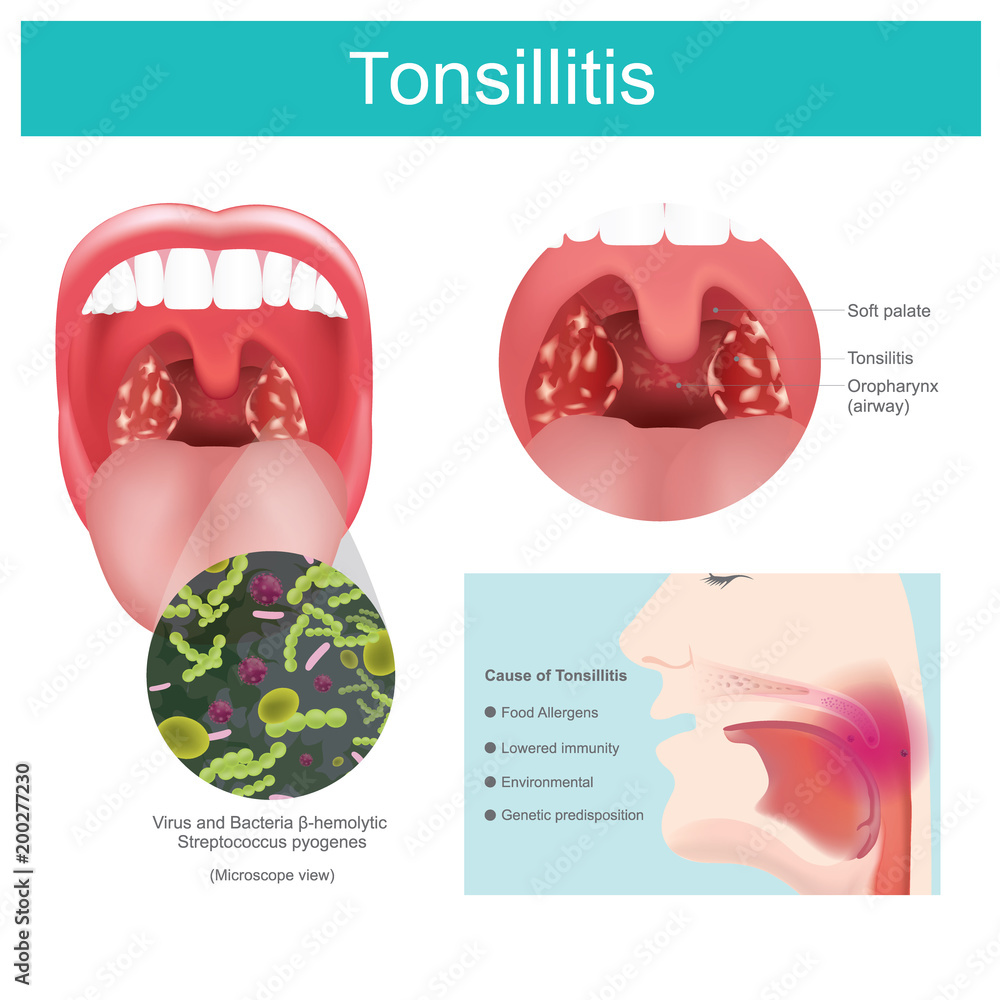 Tonsillitis. Inflammation of the soft tissue in the mouth and pain in ...