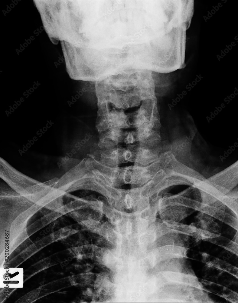 Xray of neck and cervical spine, front view. Stock Photo | Adobe Stock
