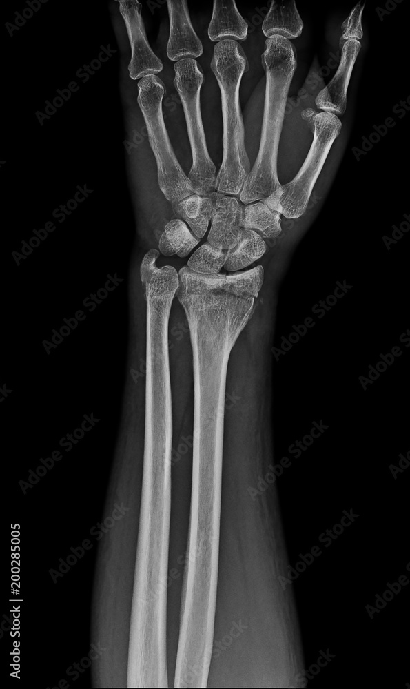 wrist x ray / x-ray show Distal Radius Fractures (Broken Wrist) Stock ...