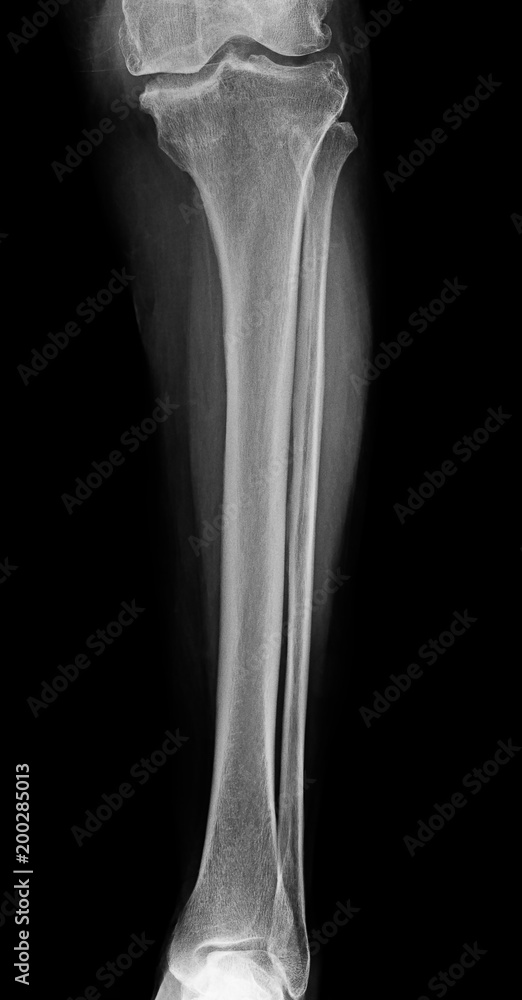 Lower leg xray , x-ray image of leg front view , xray of normal leg ...
