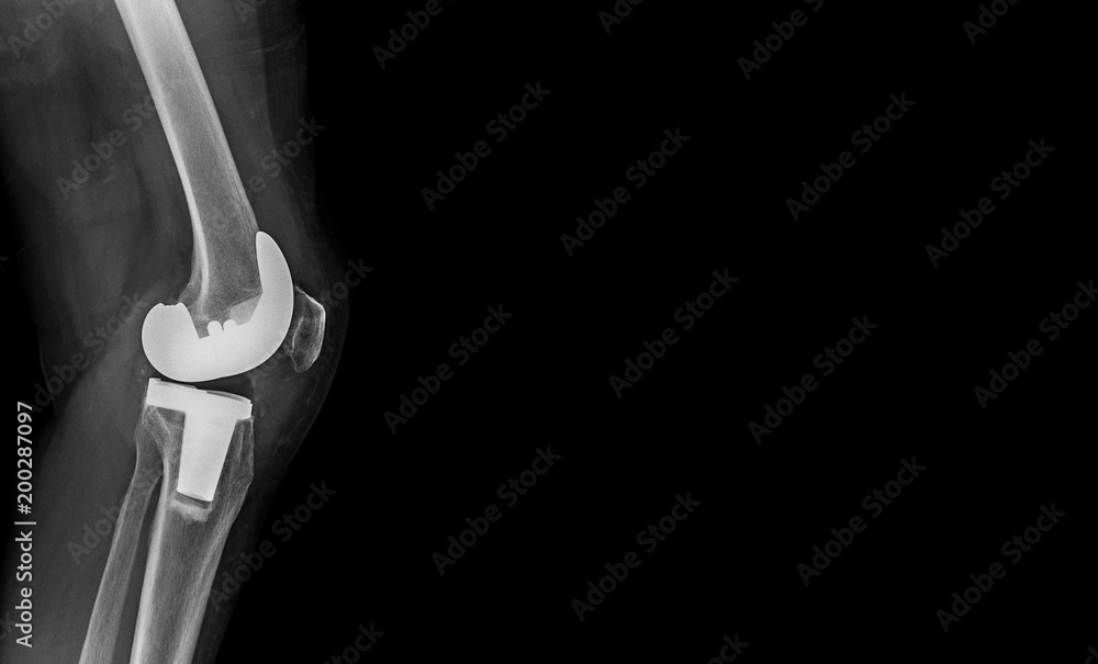 x-ray image of total knee arthroplasty / total knee replacement side ...