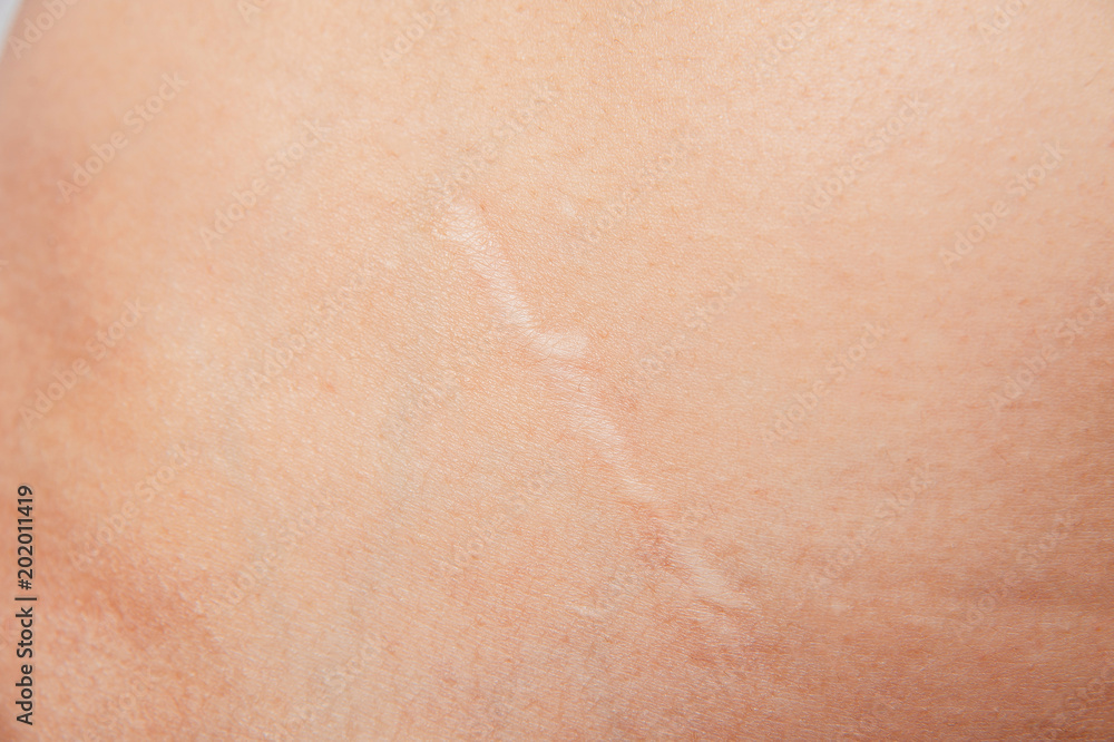 Scars removal concept. Young woman with large scar after surgery on ...