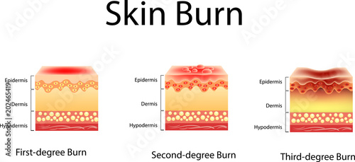 skin burn. Three degrees of burns. type of injury to skin, Vector ...