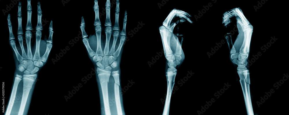 x-ray image and and forearm AP/Lateral view Stock Photo | Adobe Stock
