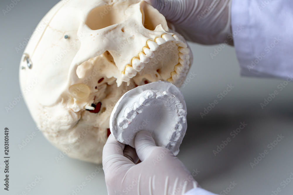 Study cast of Diagnostic cast and dental gypsum models in dental ...