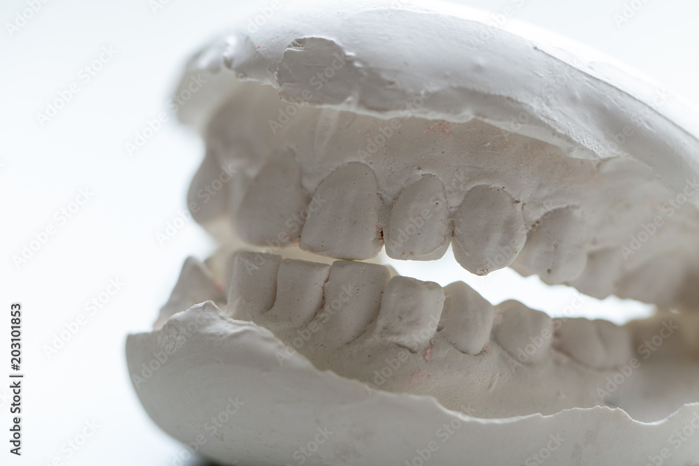 Foto de Stock Study cast of Diagnostic cast and dental gypsum models in ...
