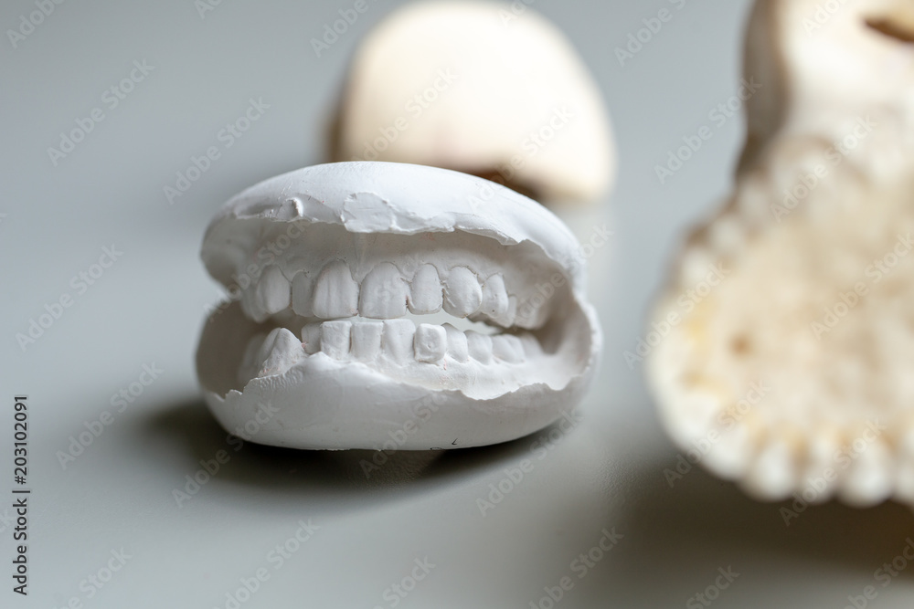 Study cast of Diagnostic cast and dental gypsum models in dental ...
