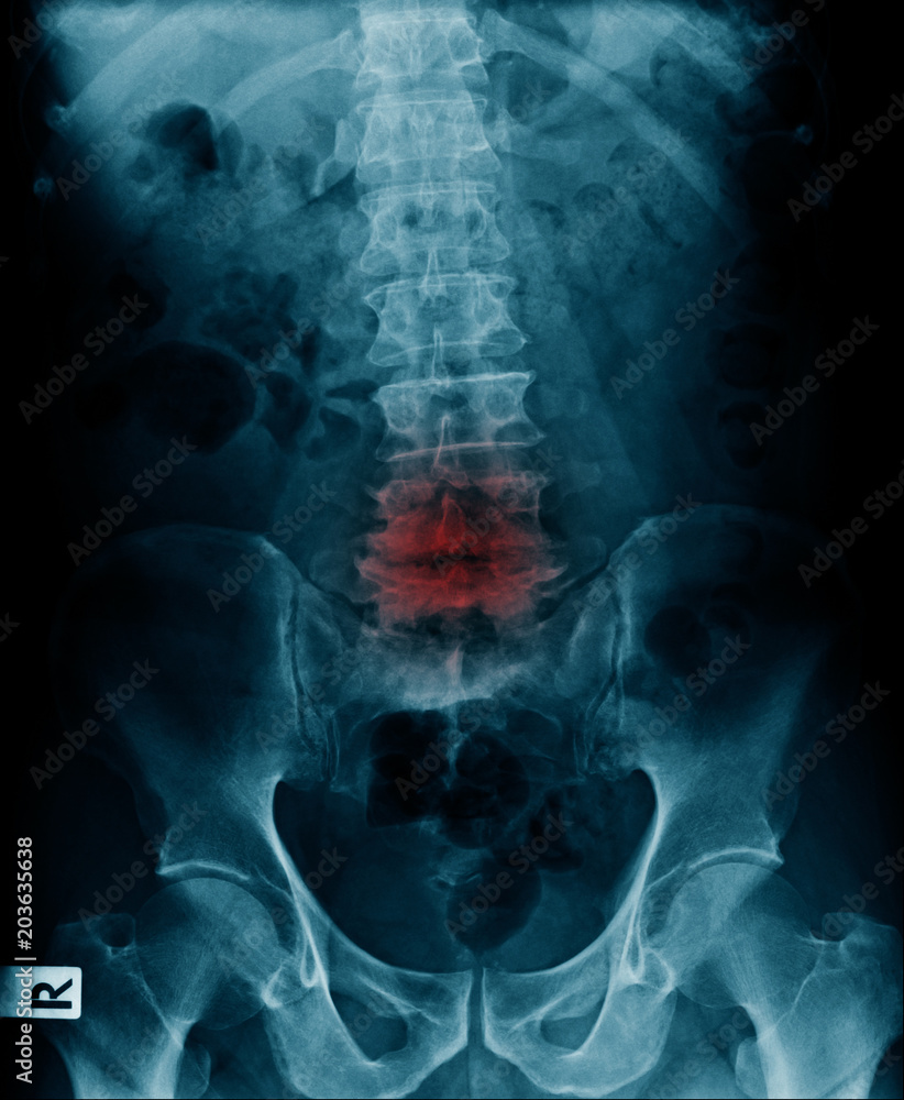 x-ray imaage show body of lumbar spine fracture, compression fracture ...