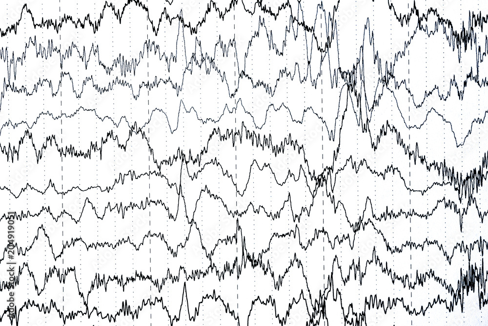 Abnormal EEG brain wave Stock Photo | Adobe Stock