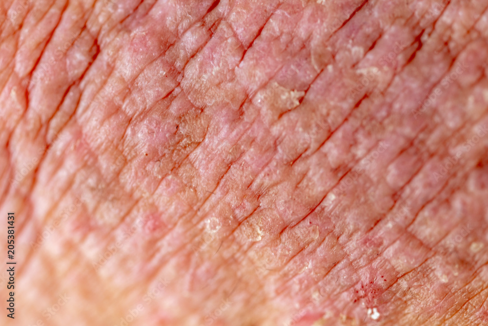 Atopic dermatitis (AD), also known as atopic eczema, is a type of ...