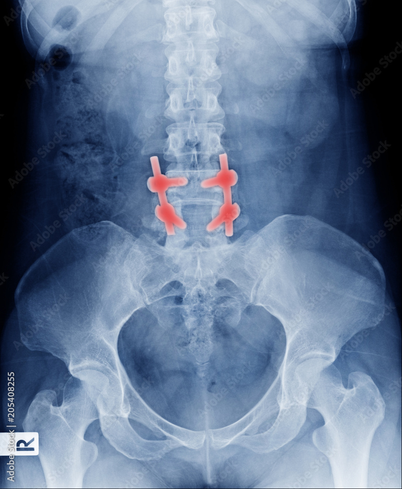 x-ray lower back of young man post fixed of lumbar spine fracture ...