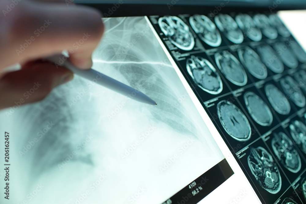 Doctor points with pen to the X-ray image of lungs hanging on a ...
