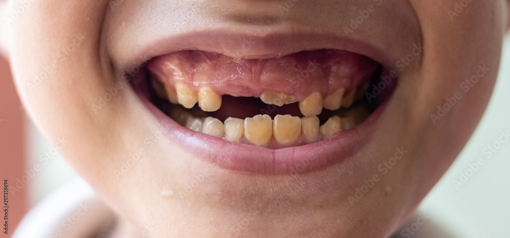 Little boy show Broken teeth.boy with a broken and rotten teeth Stock ...