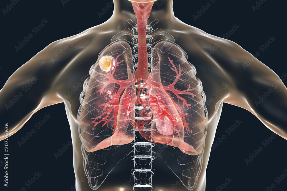 Aspergilloma of the lung, 3D illustration. Also known as mycetoma, or ...