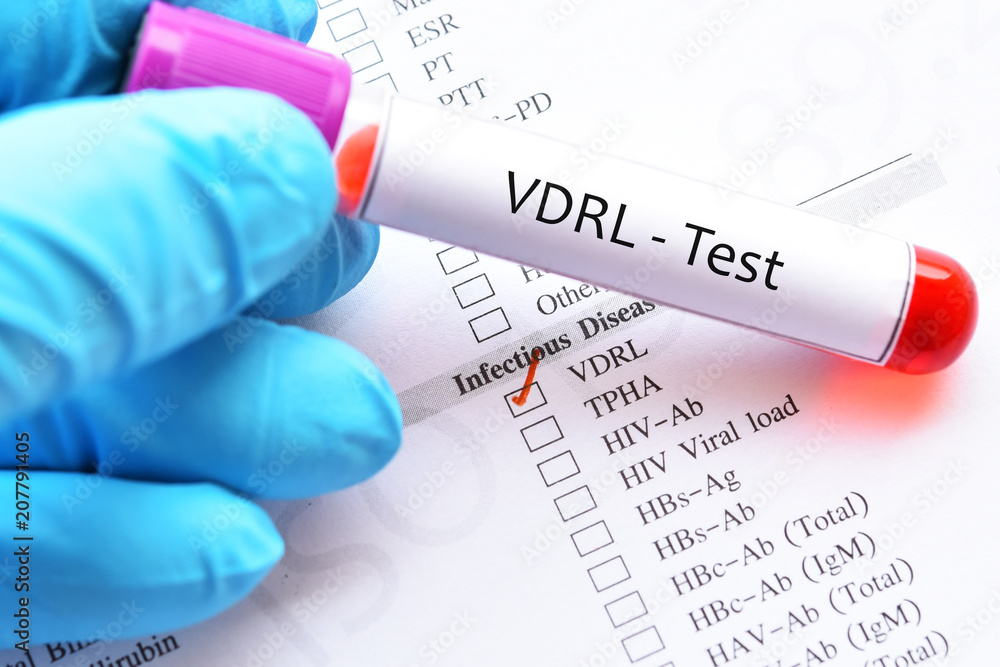 Blood sample tube with laboratory requisition form for VDRL test ...
