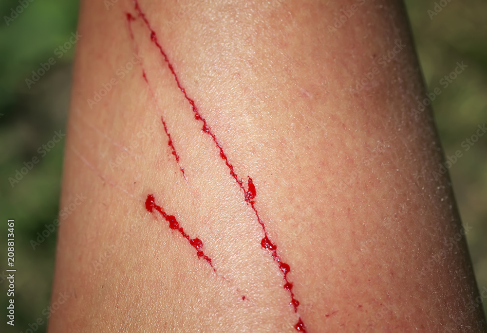 pain and itching from the wound and scratches with drops of blood on ...