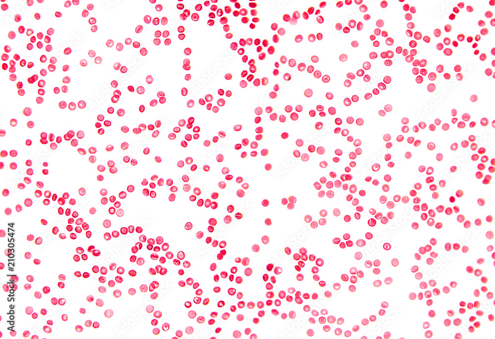 Human blood cells under microscope. Magnified smear of red blood cells ...