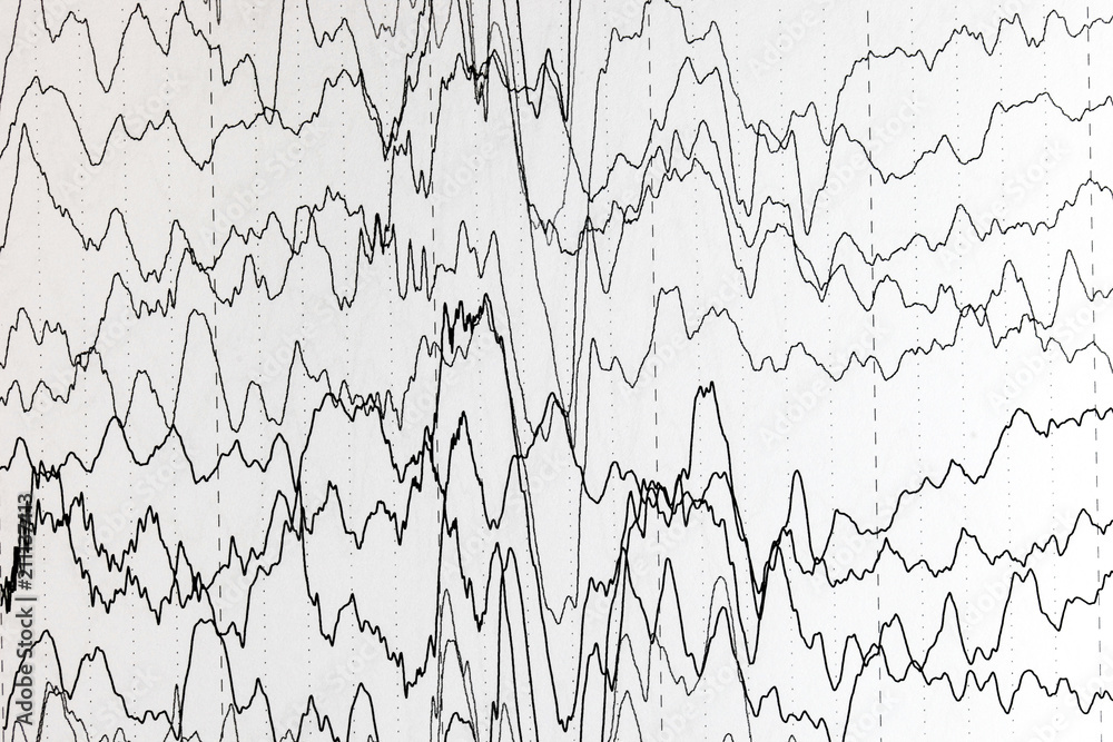 EEG of the pediatric patients, problems in the electrical activity of ...