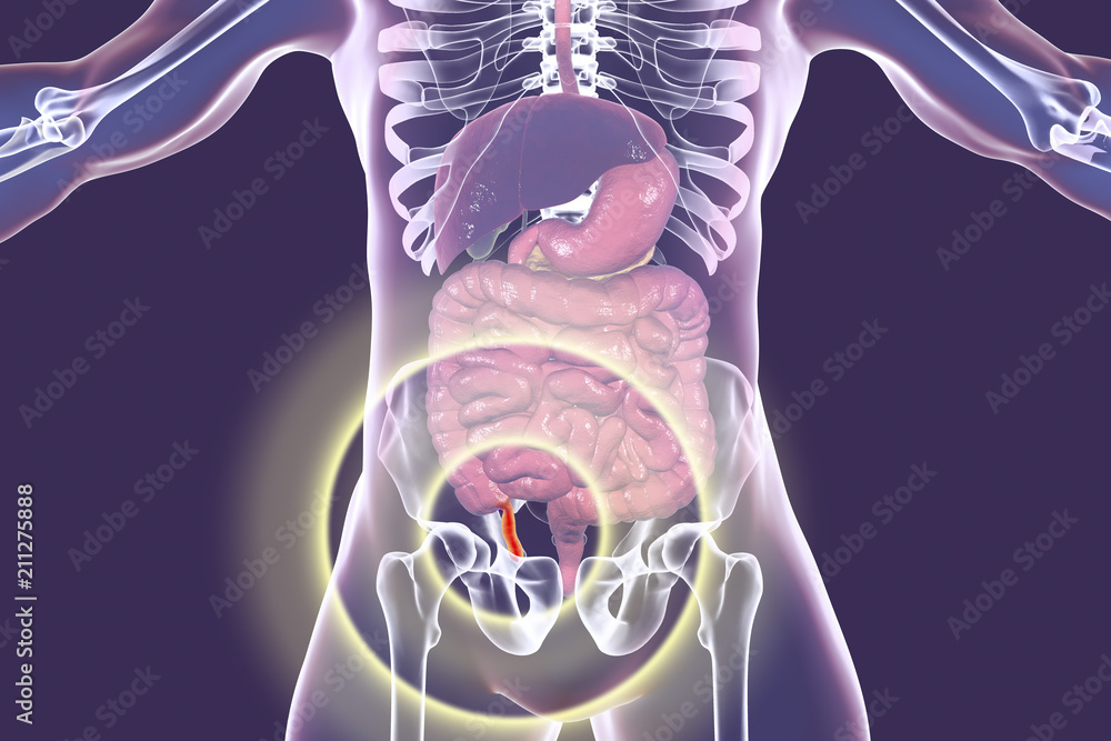 Acute appendicitis, 3D illustration showing inflammed appendix inside ...