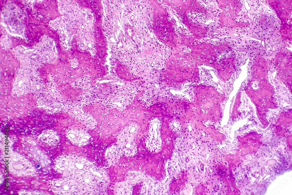 Histology of callus, a thickened skin made as a result of pressure ...
