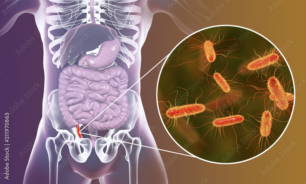Acute appendicitis caused by bacteria Escherichia coli, Gram-negative ...