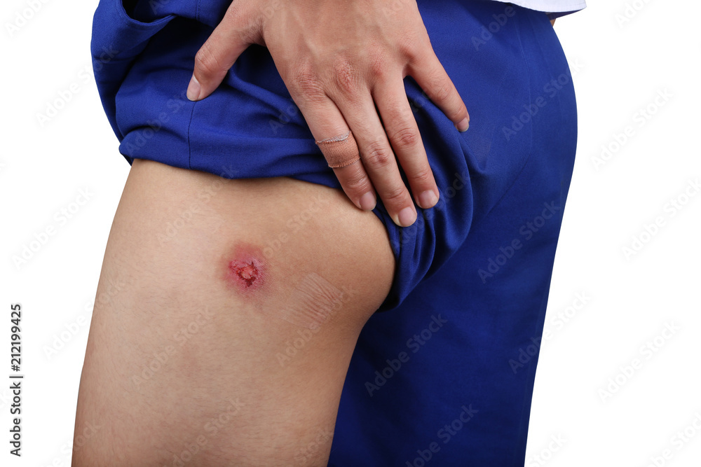 Bruised wound injury on skin butt or skin bum of Asian young boy. Close ...