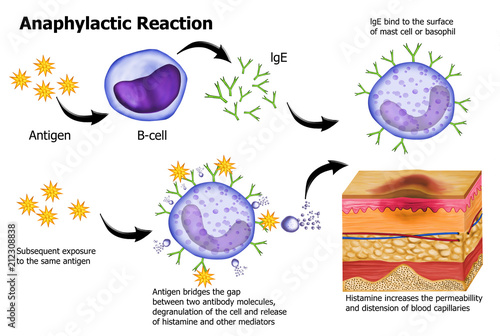 Mechanism of allergy Stock Illustration | Adobe Stock