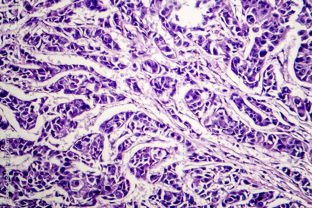 Lymph node cancer, light micrograph, photo under microscope Stock Photo ...