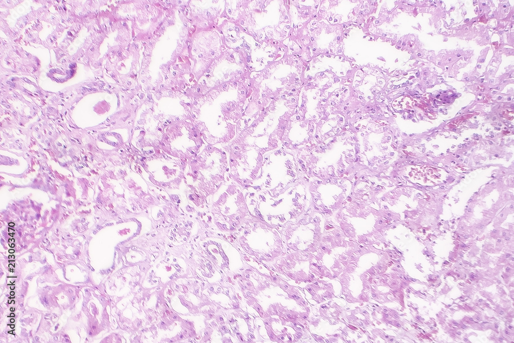 Tubular epithelial edema, light micrograph, photo under microscope ...