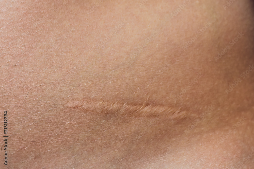 scar after surgery. Before after removal. Stock Photo | Adobe Stock