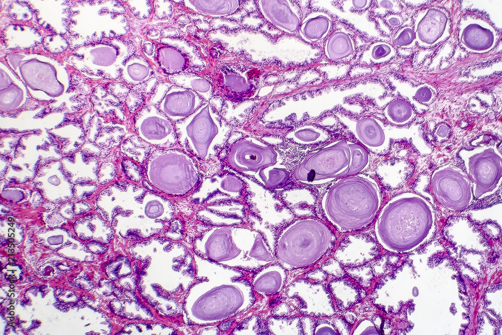 Benign prostatic hyperplasia. Micrograph shows dilated glands ...