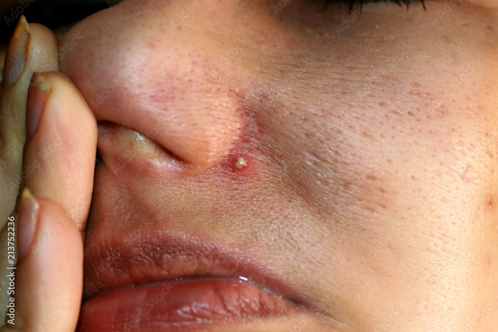 Inflamed skin of the face. Acne. Pimple purulent on the nose. Stock ...