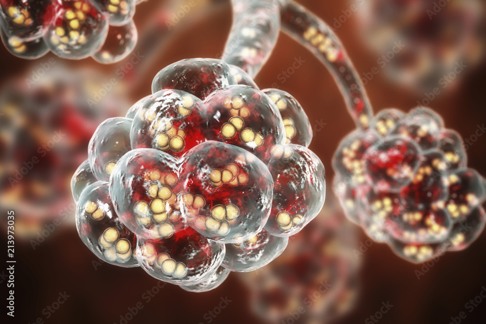 Pneumococcal pneumonia, medical concept. 3D illustration showing ...