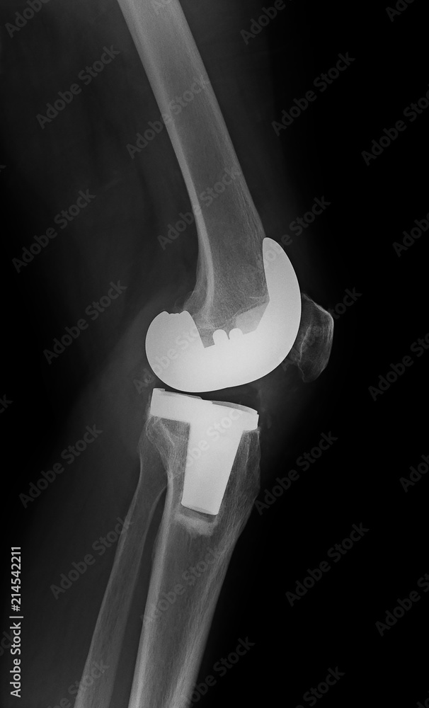 Foto de Stock x-ray image of total knee arthroplasty / total knee ...