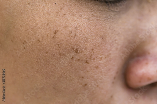 Freckles Over Asian Woman Face, Skin Problems Stock Photo | Adobe Stock