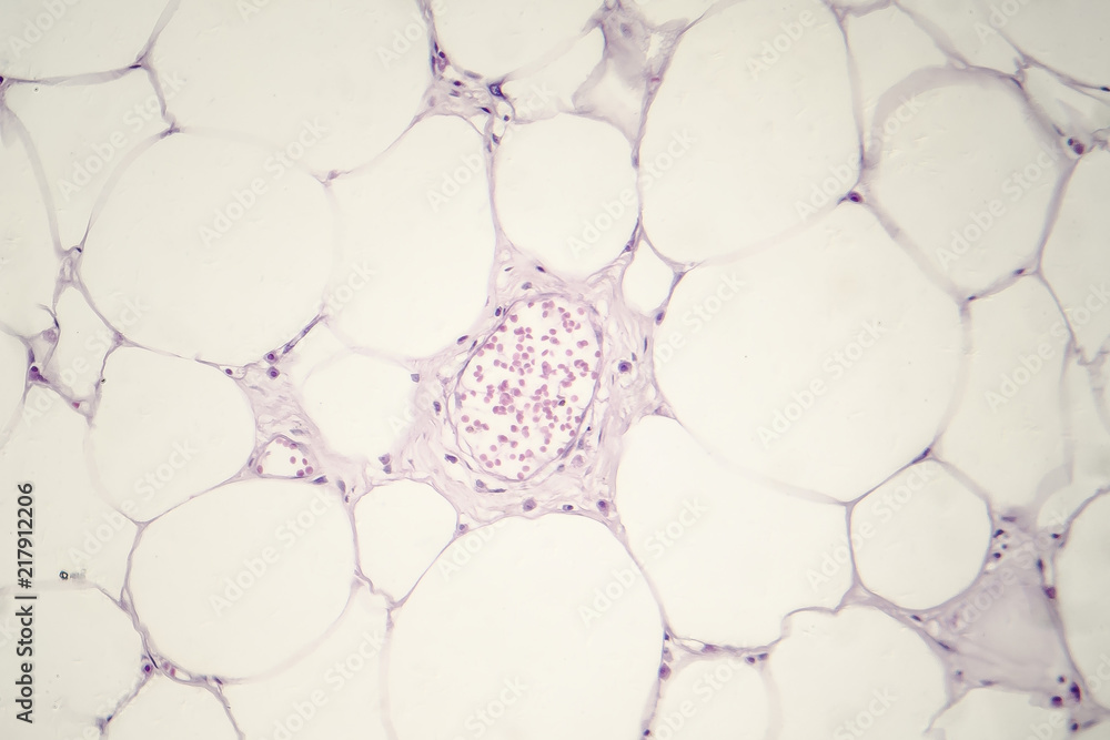 Lipoma, benign growth of fatty tissue, light micrograph, photo under ...