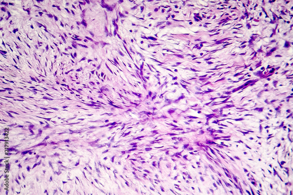 Fibroma, a benign tumour of fibrous tissue, light micrograph, photo ...