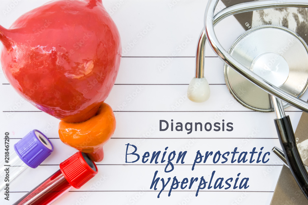 Diagnosis of Benign Prostatic Hyperplasia. Medical concept picture of ...
