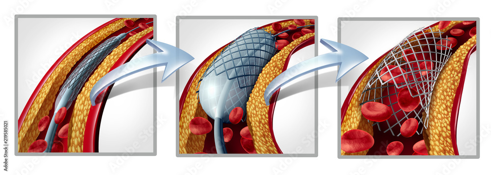 Coronary Stent Diagram Stock Illustration | Adobe Stock