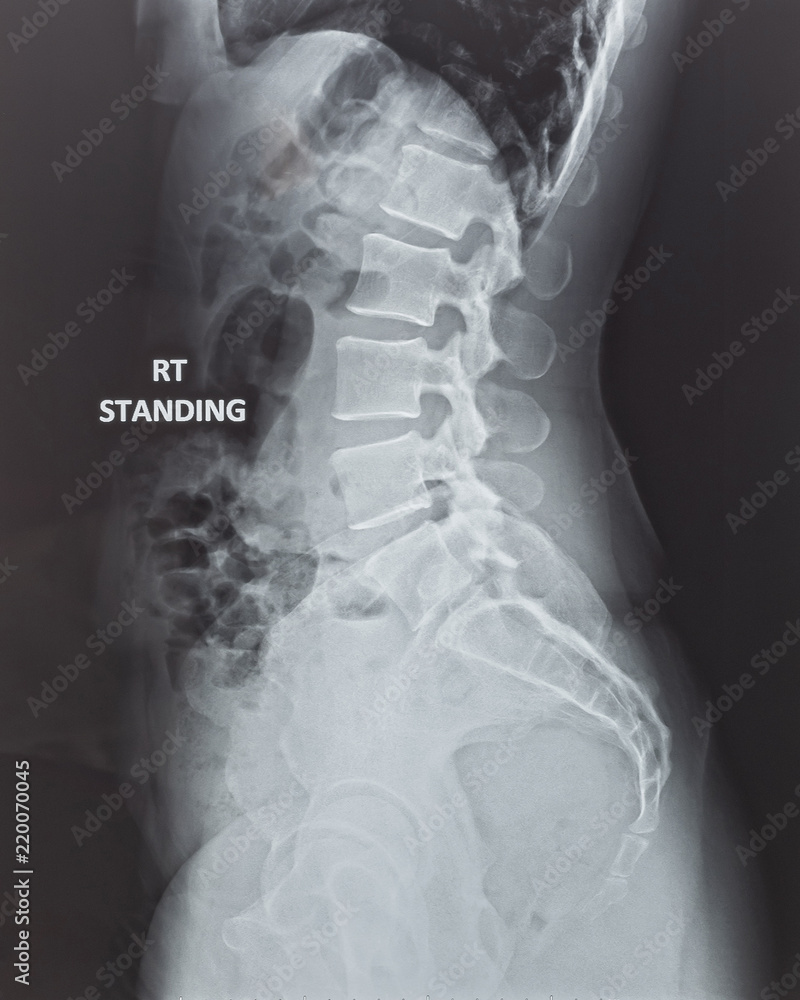 X-ray of human back spine cord radiography with digital imaging film ...