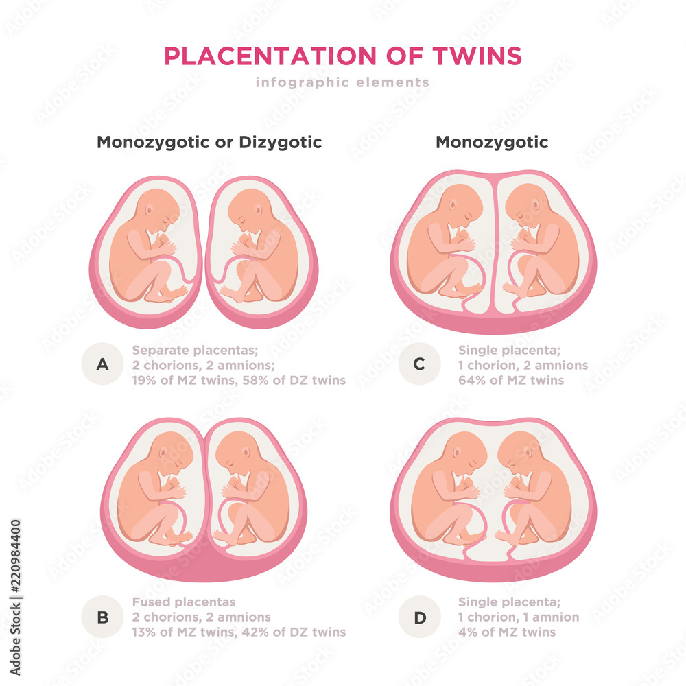 Twin types infographic elements in flat design. Monozygotic or ...