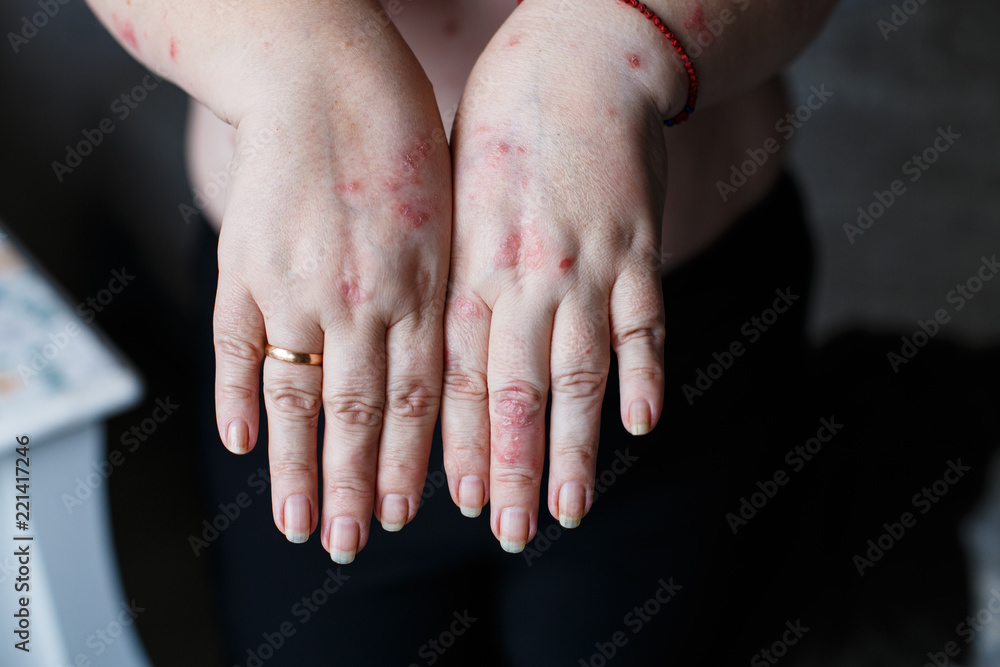 Psoriasis vulgaris on the womans hands with plaque, rash and patches on ...