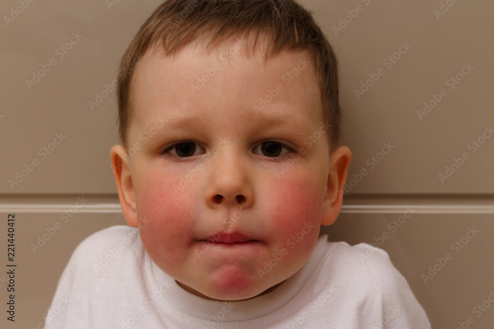 Photo Stock the boy has red cheeks, a rash on his cheeks in the child ...