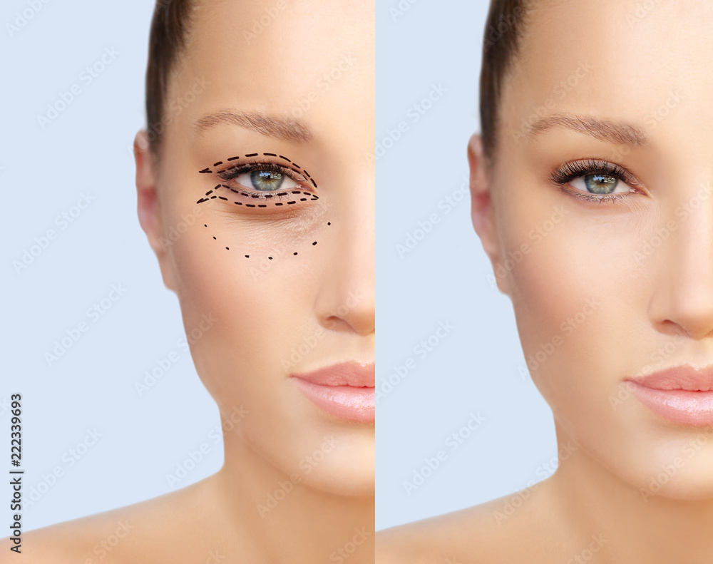 Lower and upper Blepharoplasty.Marking the face.Perforation lines on ...